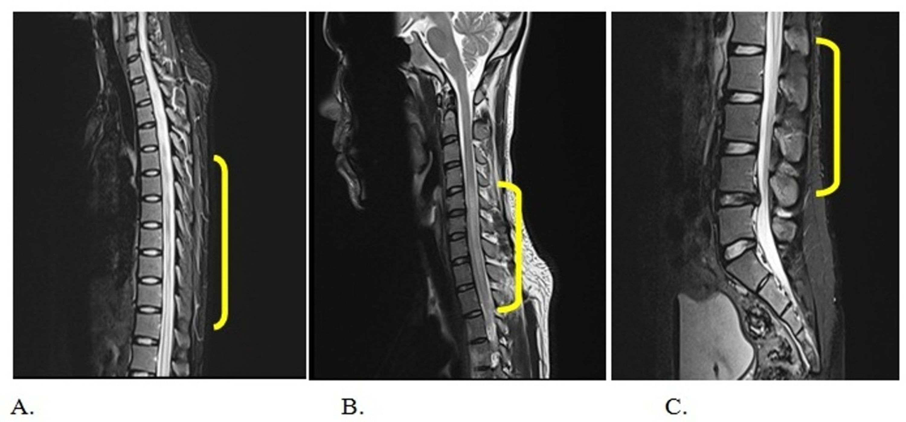 Transverse Myelitis Transverse Myelitis Neurology Medbullets Step